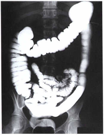 Double Contrast Barium Enema Preparation Diet - connews