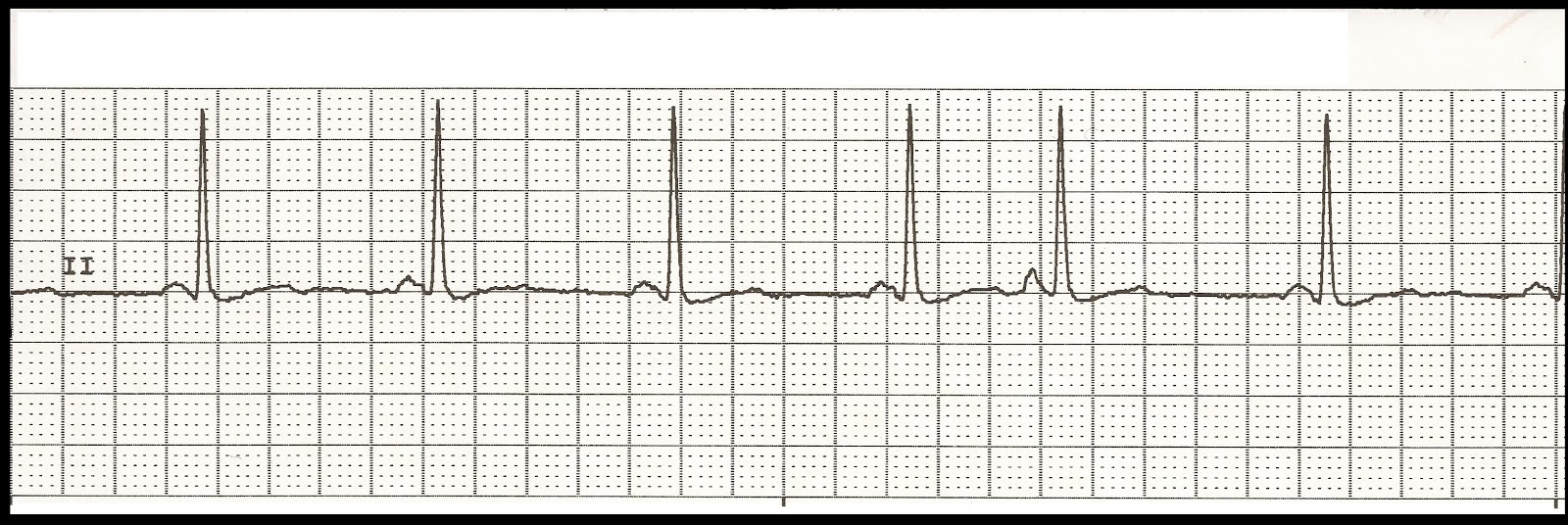 Basic ECG Rhythm Test 03