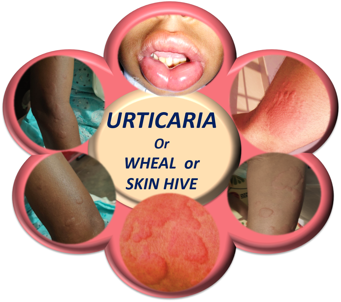 Urticaria or Wheal or Skin Hive
