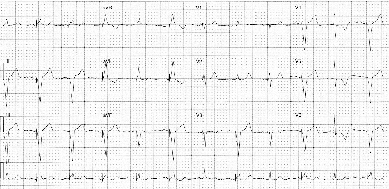 ECG of the Week: ECG of the Week - 21st November 2016 - Interpretation