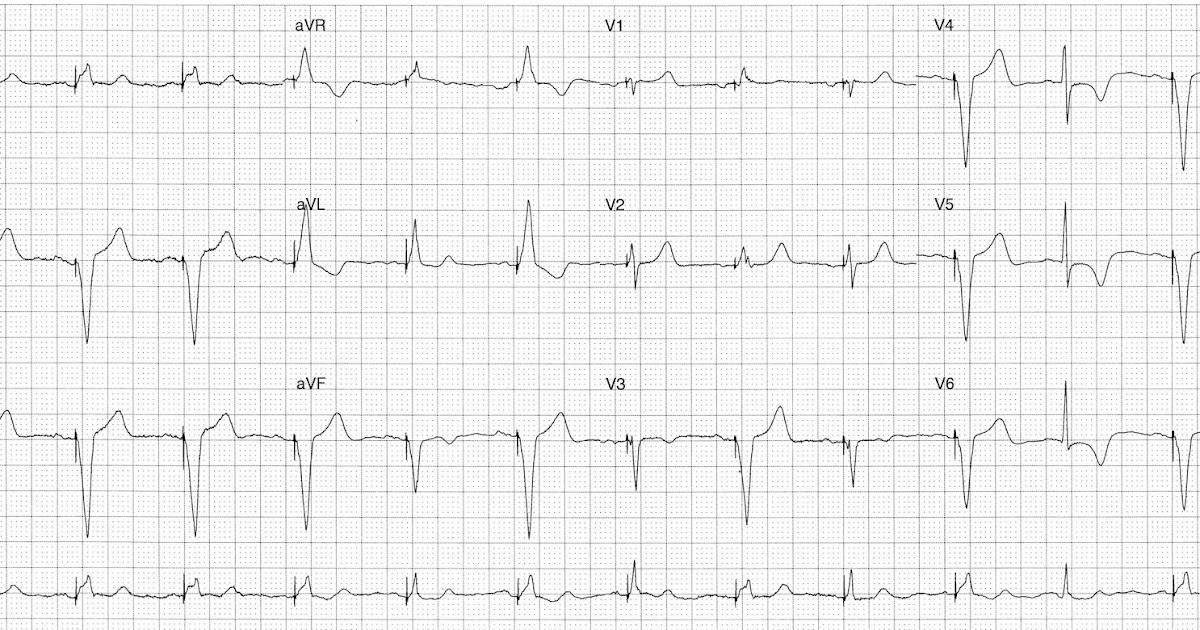 ECG of the Week: ECG of the Week - 21st November 2016 - Interpretation