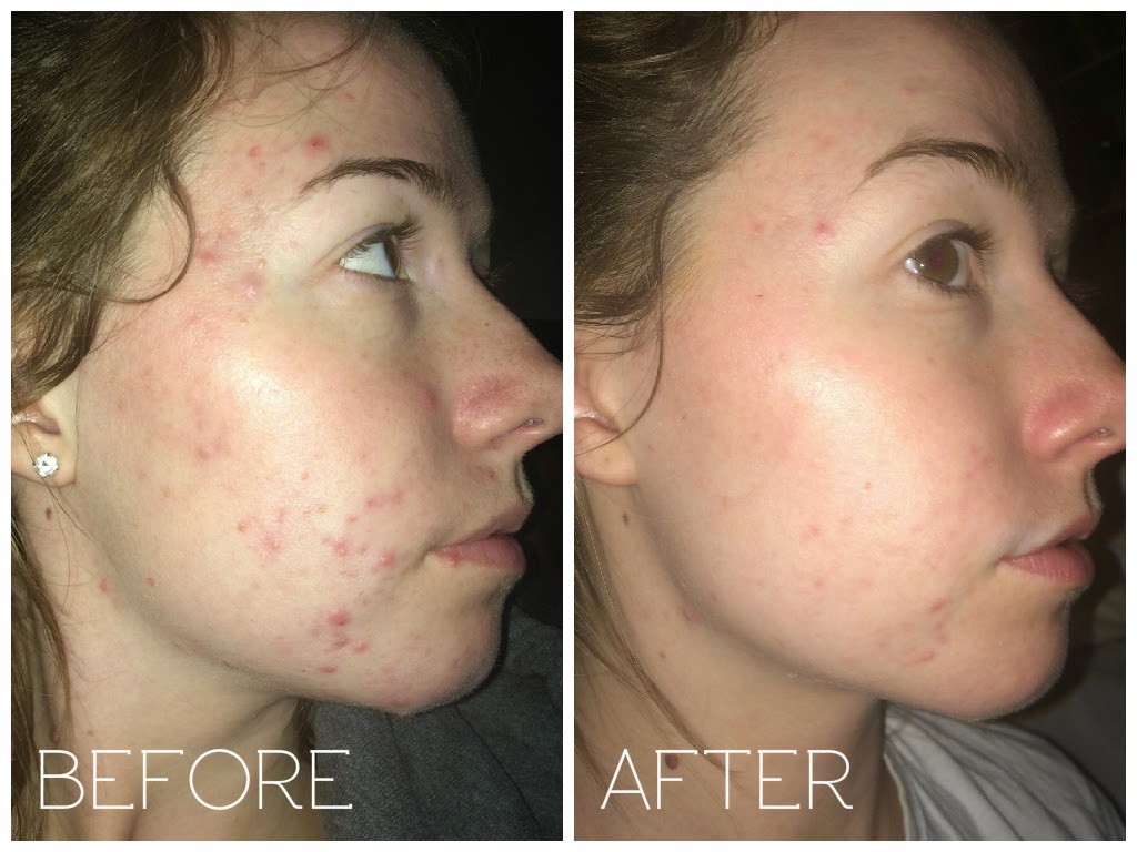 Six steps to clearer skin | Emma Francis