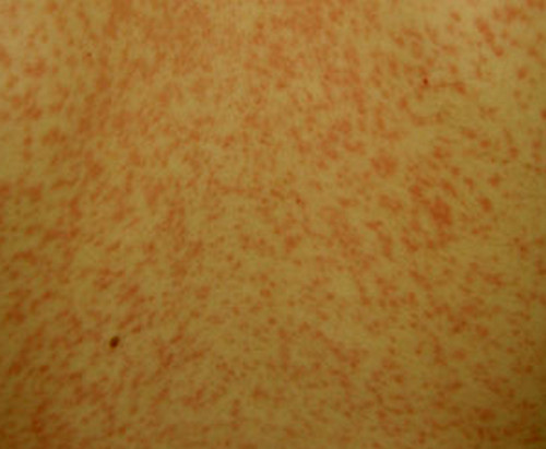 Mono Rash Pictures | Medical Pictures and Images - (2023 Updated)
