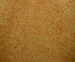 Mono Rash Pictures | Medical Pictures and Images - (2018 Updated)