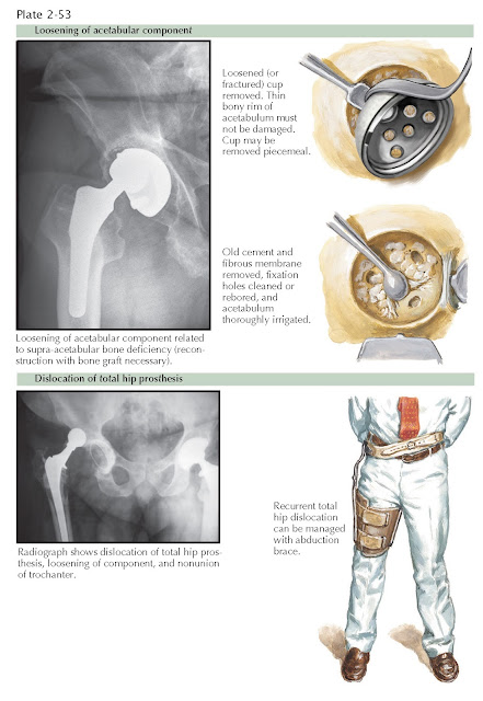 TOTAL HIP REPLACEMENT: COMPLICATIONS - pediagenosis