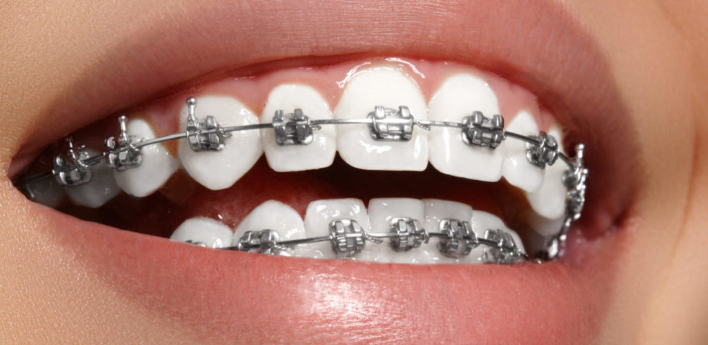 Invisalign, la ortodoncia invisible - Teleteknos