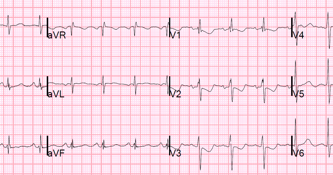 Dr. Smith's ECG Blog: ST Depression and T-wave inversion in V2 and V3.