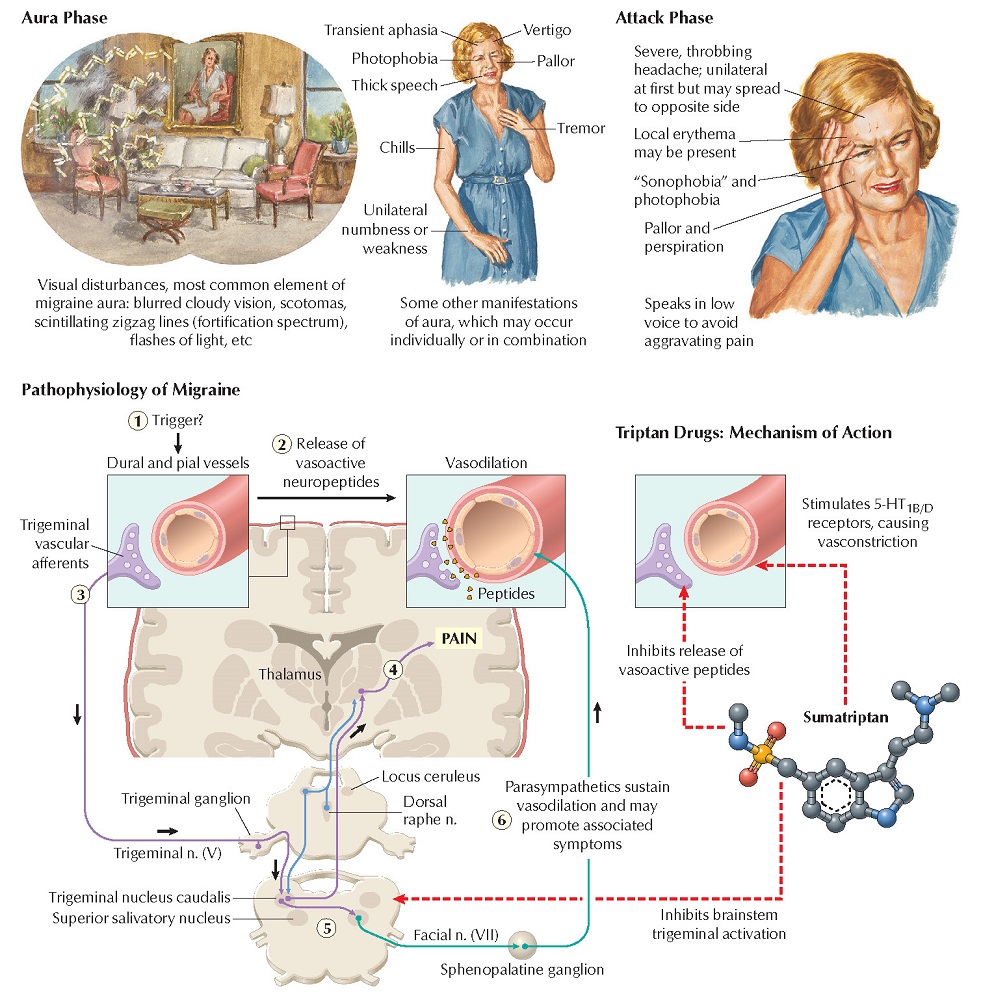 Sumatriptans and Reuptake Inhibitors - pediagenosis