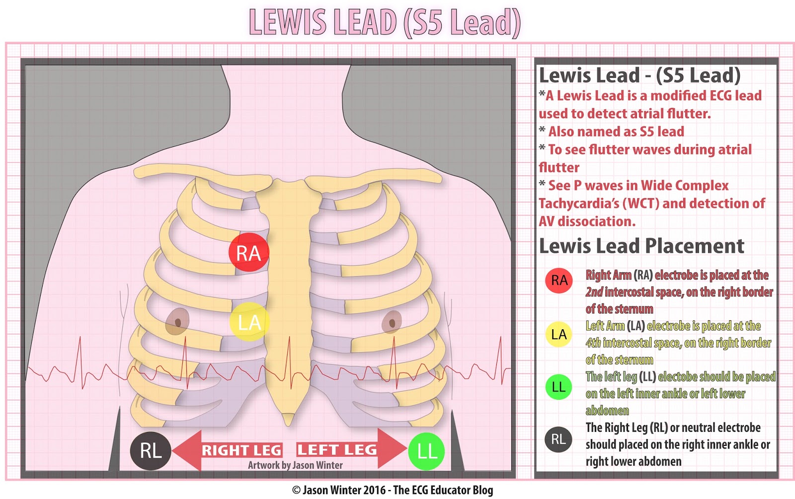 ECG Educator Blog : Atrial Flutter