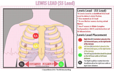 ECG Educator Blog : Atrial Flutter