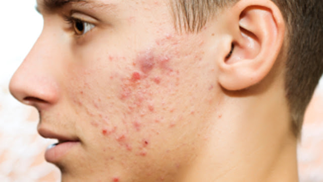 How to Deal with Acne: 5 Care and Prevention Tips - Beauty Tips