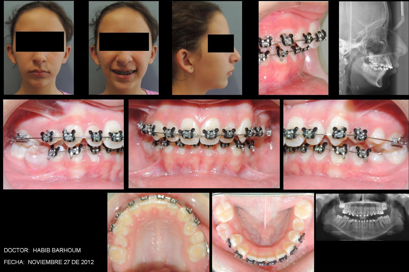 ORTODONCIA INVISIBLE HABIB BARHOUM: ADVANSYNC 2 - ORMCO