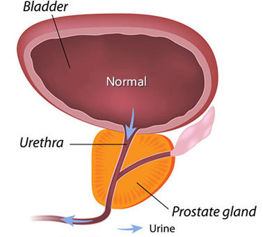 Homoeopathy Info: Enlargement of the prostate glands