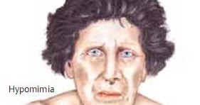 My Blog : 4 Trastornos de la psicomotricidad