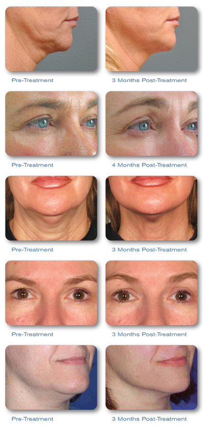 Perfect Body Laser and Aesthetics: Non-Surgical Neck Lift