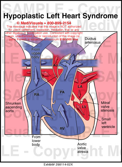 The RanDoM happenings of us: Shone's Complex