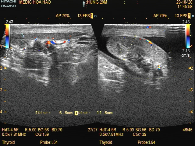 VIETNAMESE MEDIC ULTRASOUND: CASE 589: TB OF TESTIS, Dr PHAN THANH HẢI ...