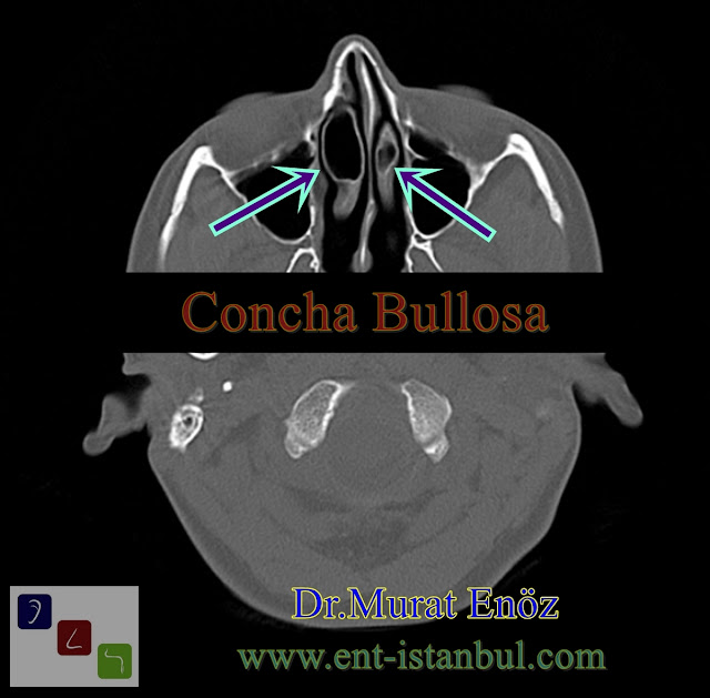 Concha Bullosa - Aerated Turbinate - Definition and Treatment