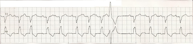 EKG Rhythm Strip Quiz 47