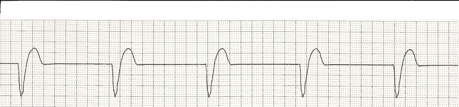 EKG Rhythm Strip Quiz 55: Ventricular Rhythms