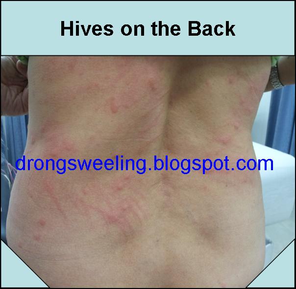 TCM News: Best TCM Doctors Treat Hives urticaria TCM Clinic