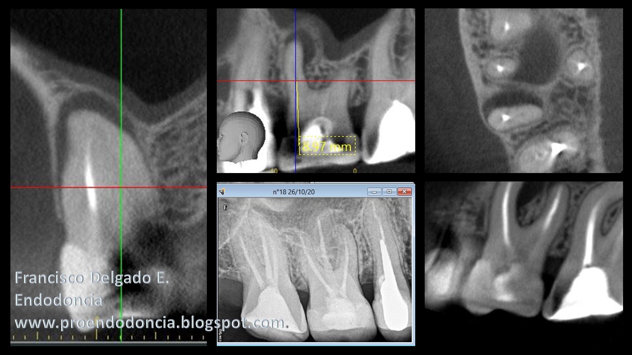 Proendodoncia.blogspot.com: puffs apicales: éxito o fracaso endodóntico