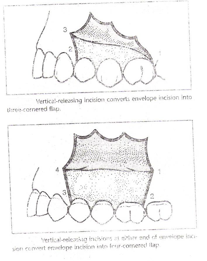 WizDent: Principles Of Complicated Exodontia-Surgical/Open method of ...