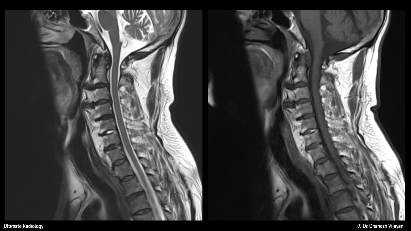 Ultimate Radiology : Diffuse Idiopathic Skeletal Hyperostosis (DISH)