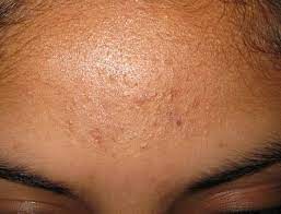 Derma-Docència Castelló: Acné: revisión del manejo en Atención Primaria