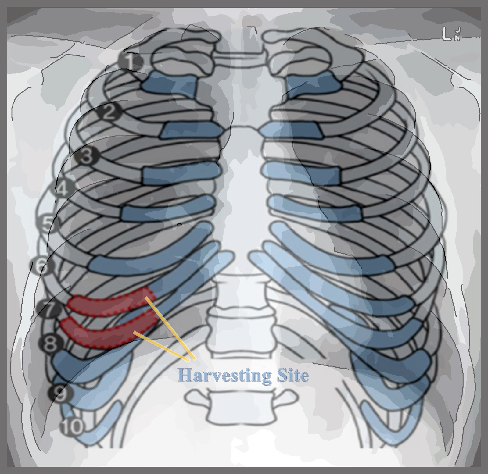 Costochondral Calcification