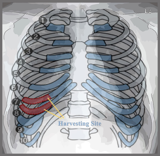Premature Calcifications of Costal Cartilages: A Different Problem For ...