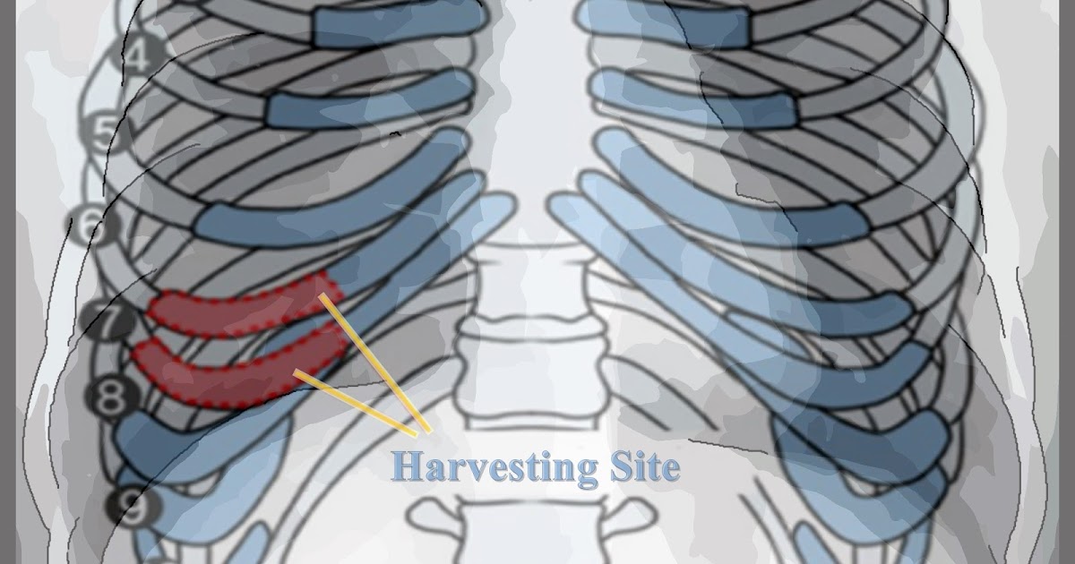 Premature Calcifications of Costal Cartilages: A Different Problem For ...