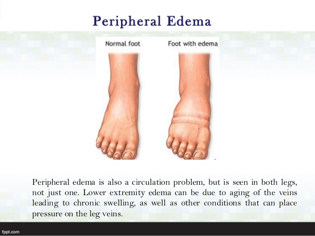 Peripheral edema