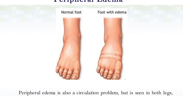 Peripheral edema
