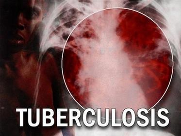 Tuberculosis Symptoms, Treatment and Precautions | Health And Safety
