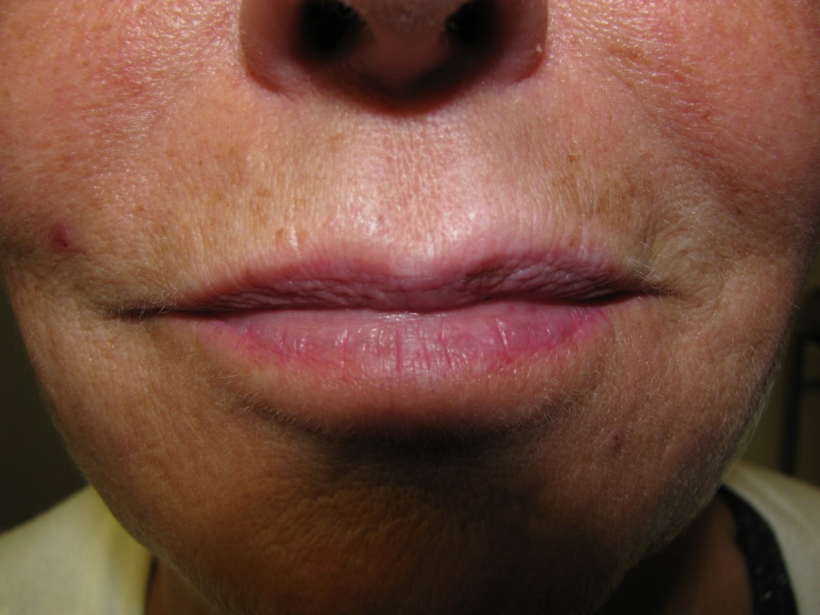 Selston Cosmetic Clinic: Youthful Looking Lips Using Dermal Fillers ...