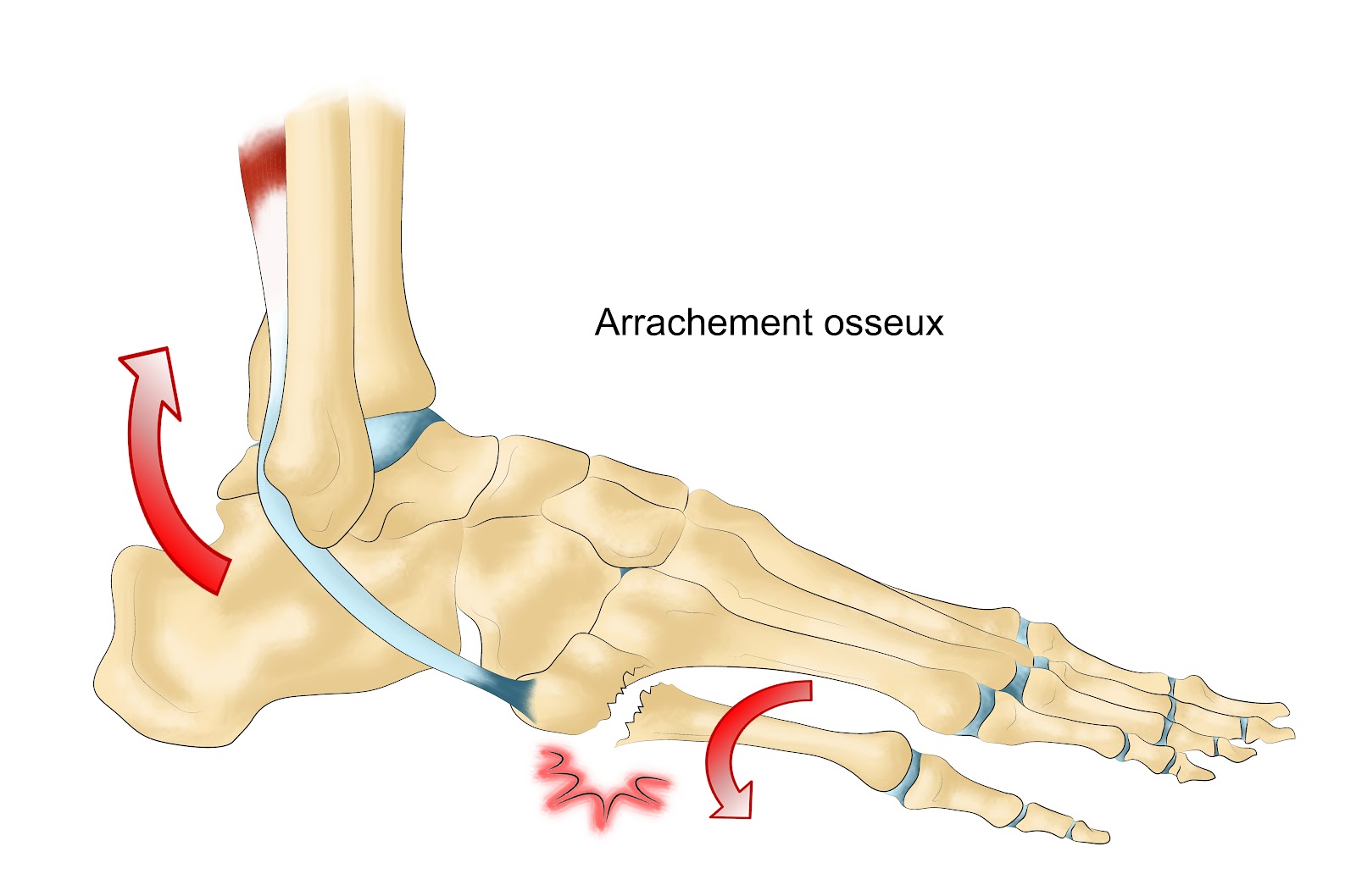 Blog 75: Infos santé : Sport et Santé-Entorse de la cheville