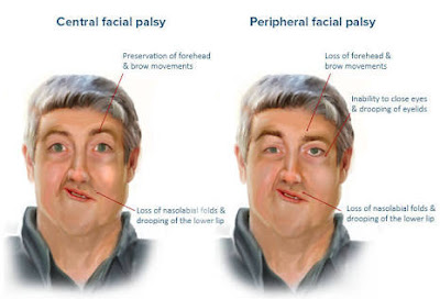 Holy Lucky Fortune.Com: Facial Paralysis (Bell's Palsy) : Sign, Symptom ...