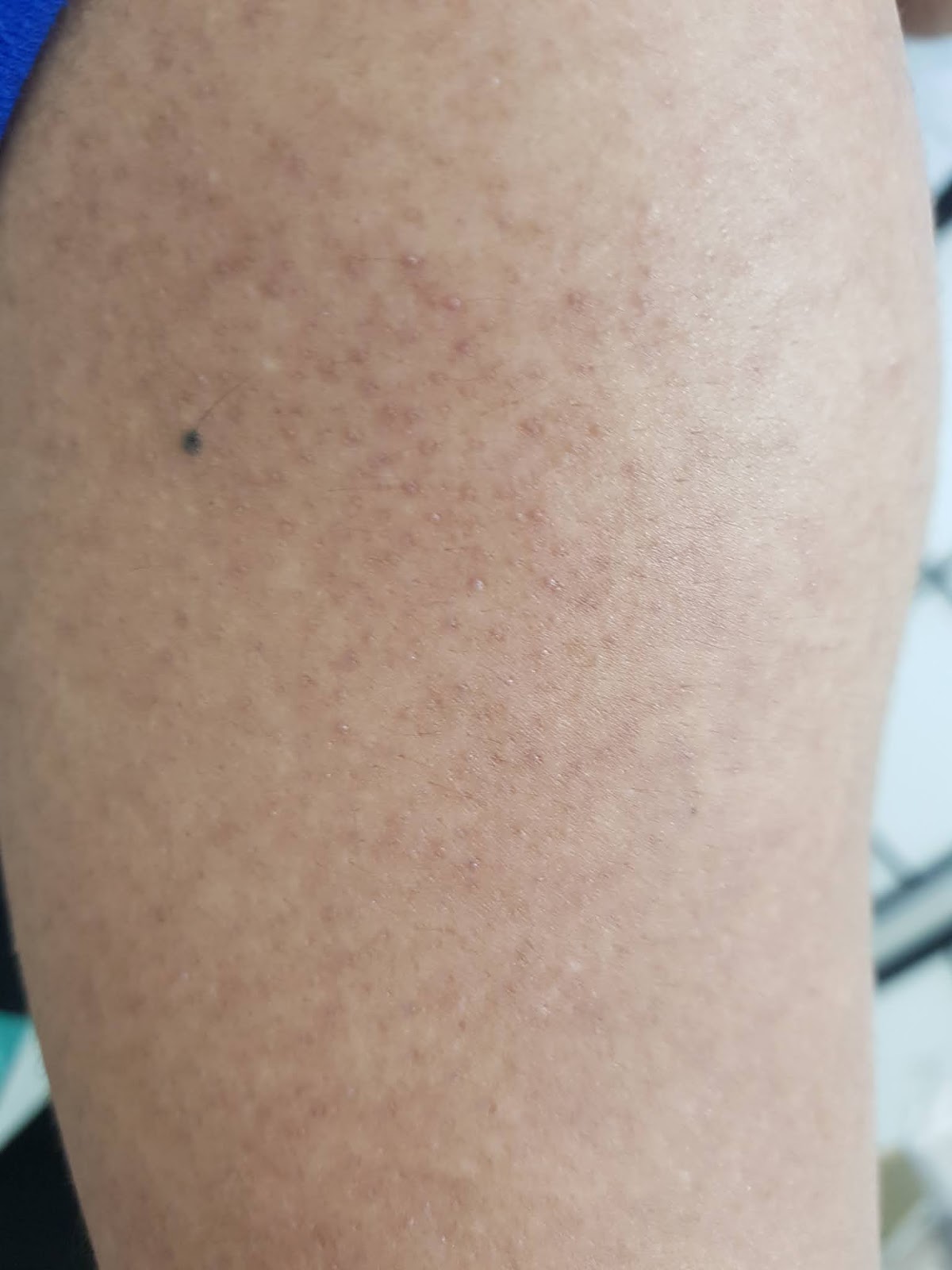 A life of a biologist: Some Pictures of common Filipino skin diseases ...