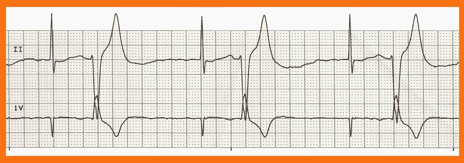 EKG Rhythm Strip Quiz 213