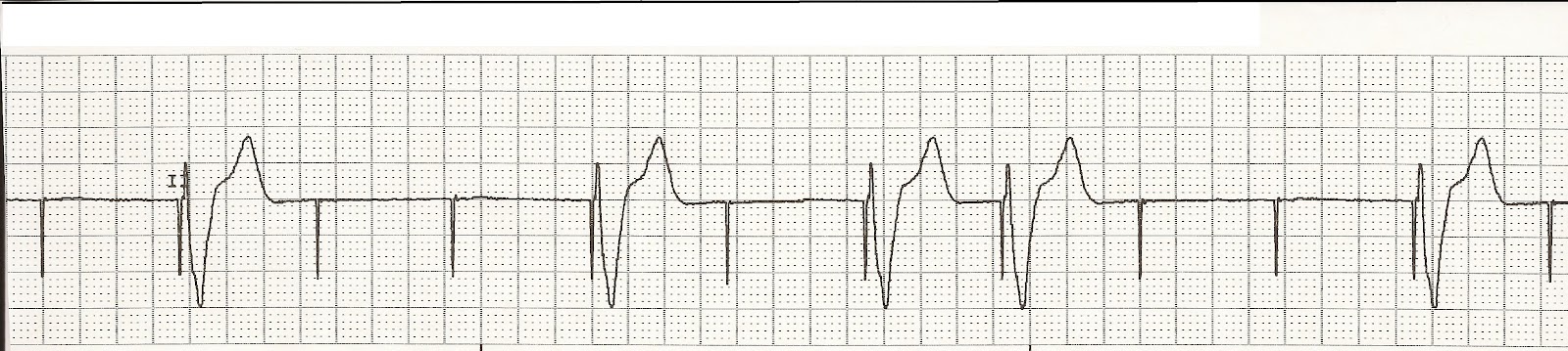 EKG Rhythm Strip Quiz 14