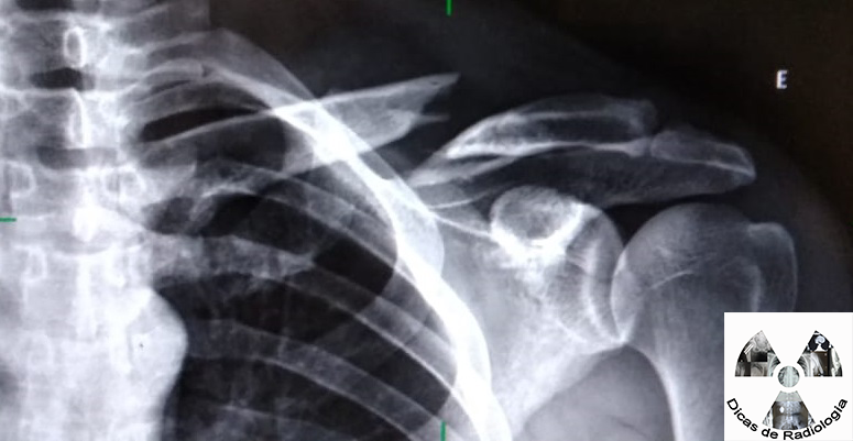 DICAS DE RADIOLOGIA - Tudo Sobre Radiologia: IMAGENS DE RAIO X ...