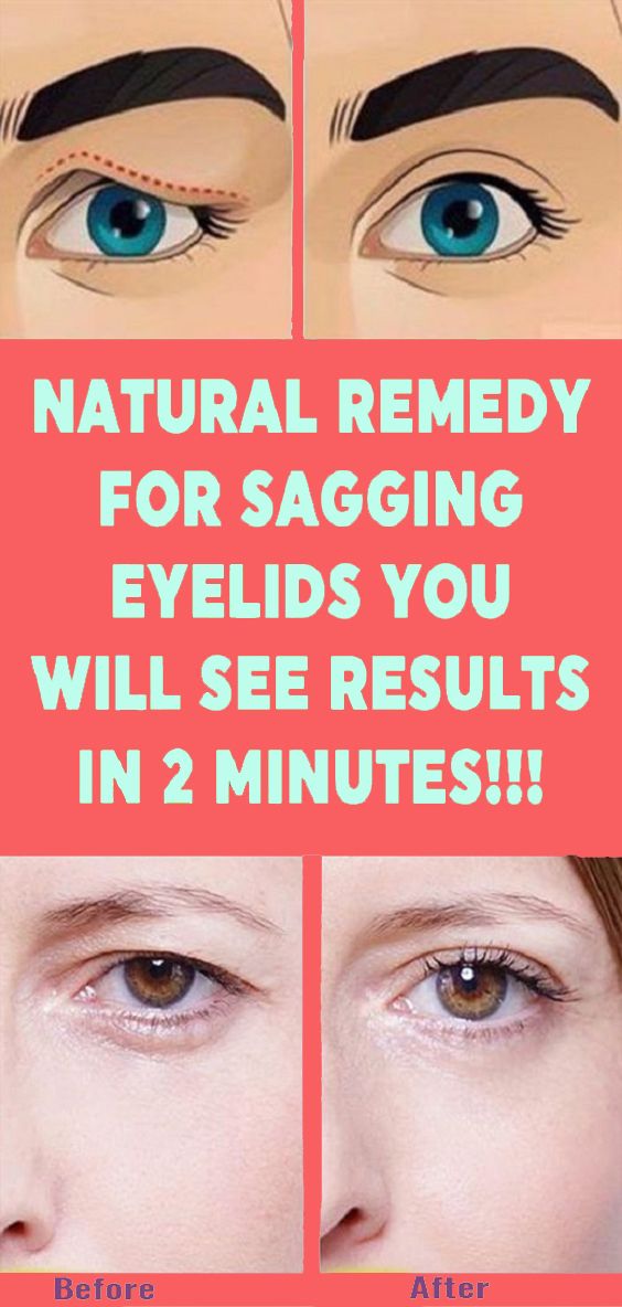 Natural Remedy for Sagging Eyelids You Will See Results In 2 Minutes ...