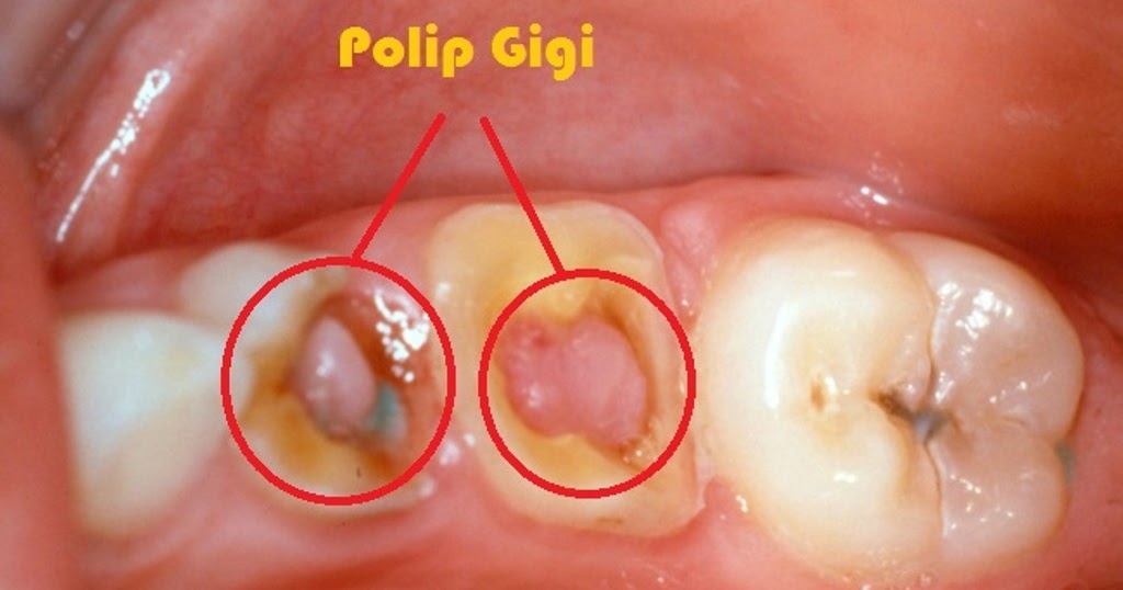 Polip Gigi : Pengertian, Gejala, Penyebab, Pencegahan dan Obatnya ~ Obat Sakit Gigi