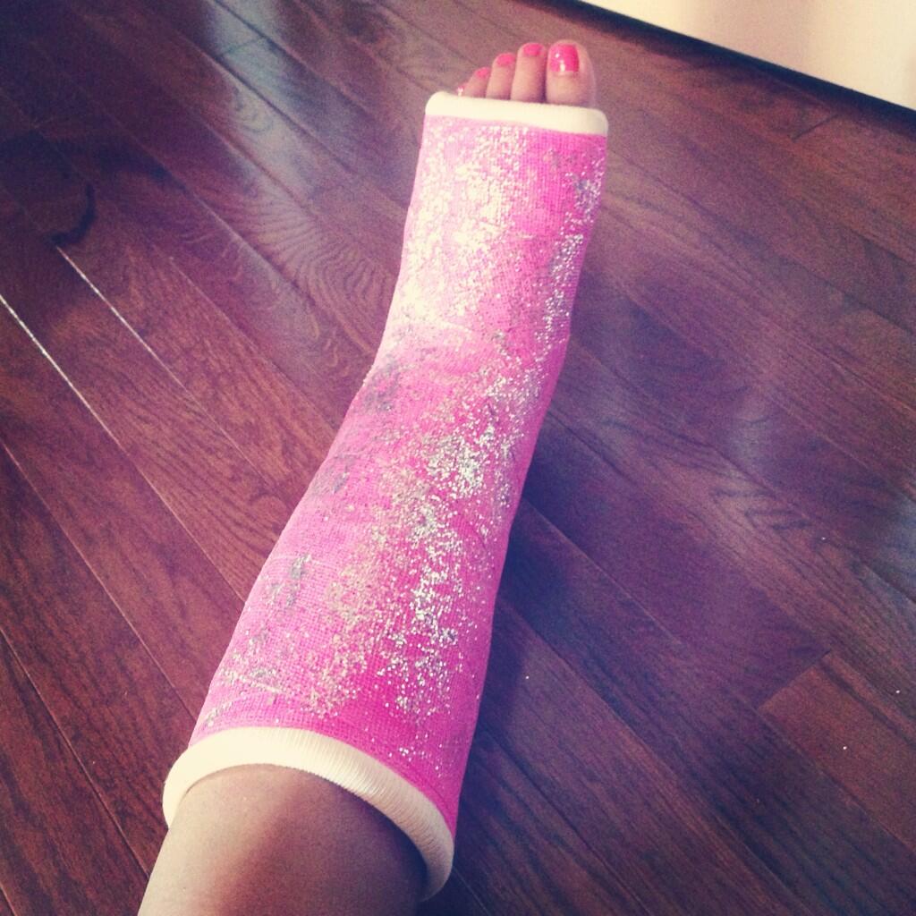 Casts and Toes: Some Short Leg Cast Pics
