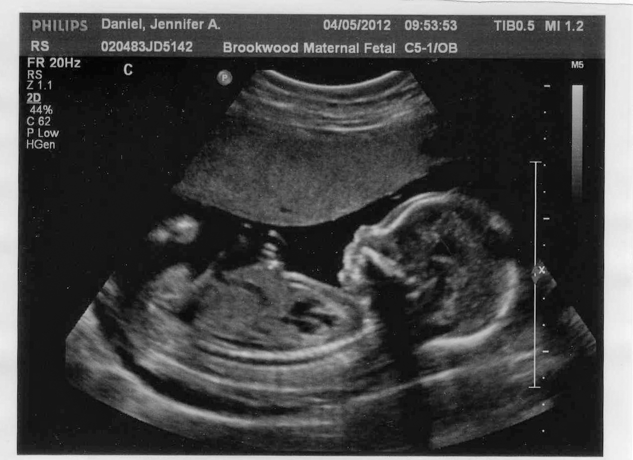 Baby Sonogram Silkfas