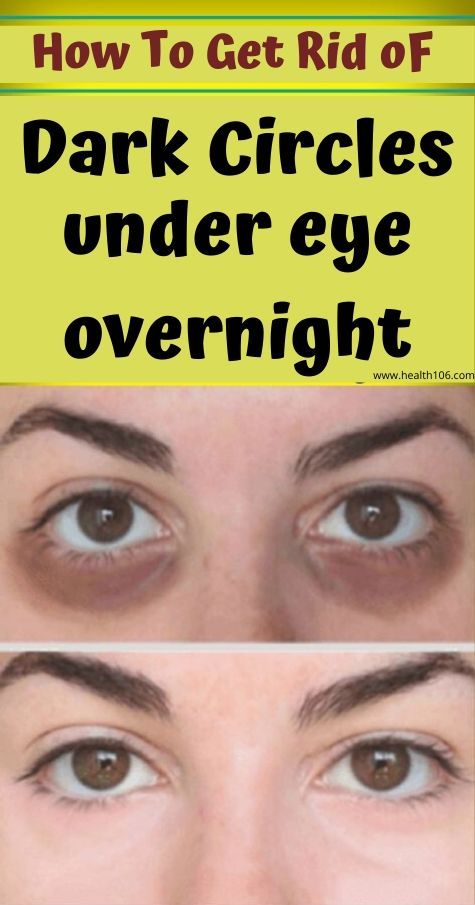 How To Get Rid Of Dark Circles Under Eyes Overnight SKINCARE how-to-get-rid-of-dark-circles-under-eyes-overnight-skincare