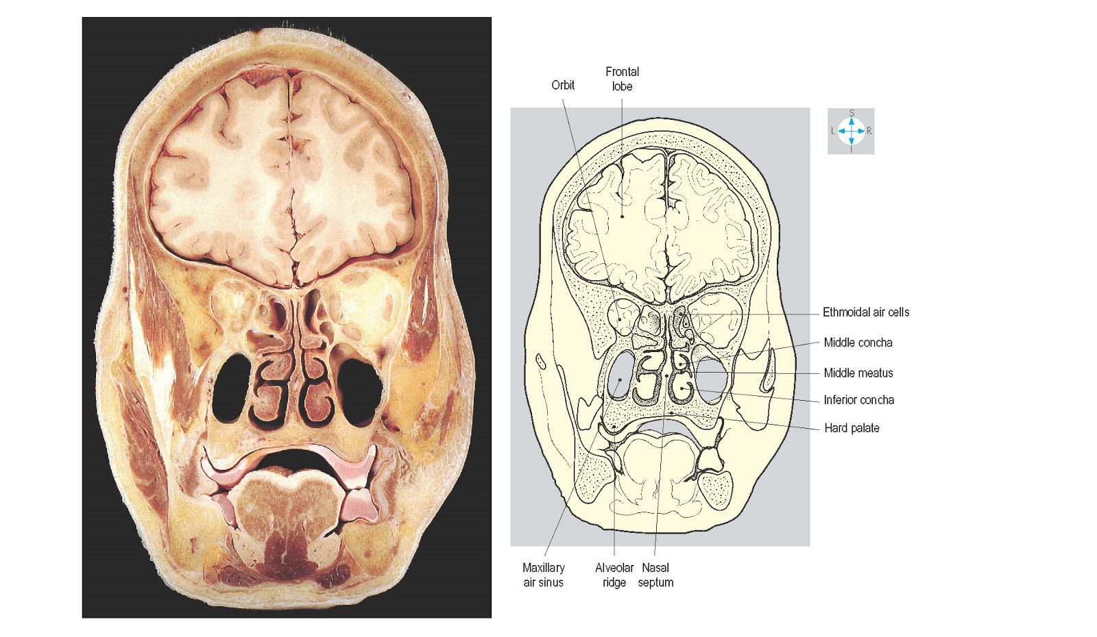 Nasal Cavities and Paranasal Air Sinuses Anatomy - pediagenosis