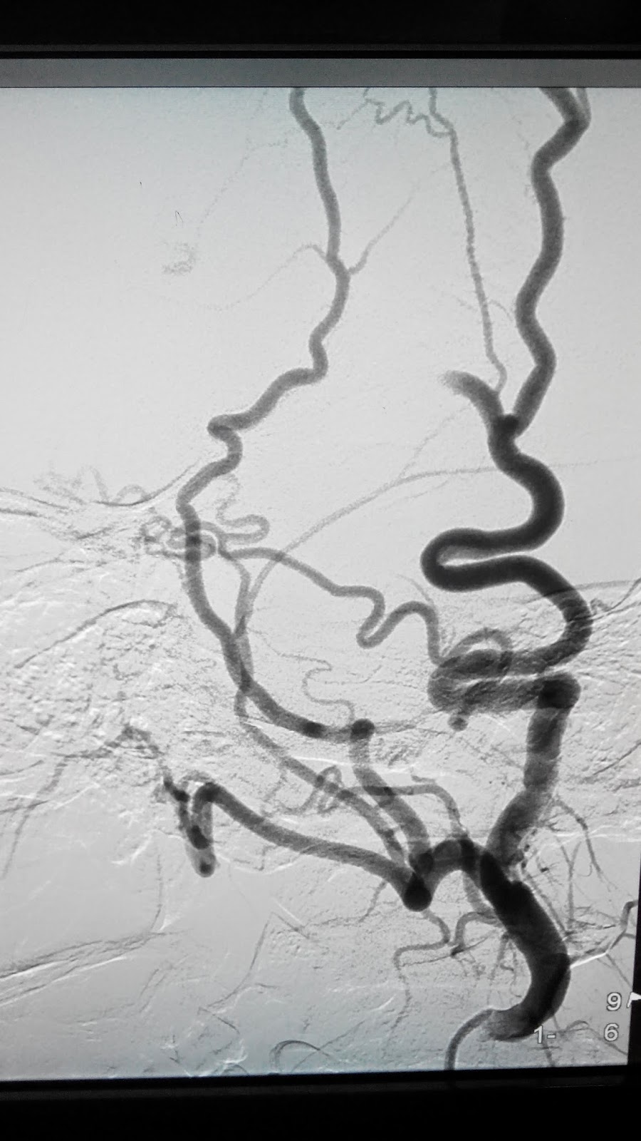 RUANG PRAKTEK BEDAH - DOKTER RAMZI SPB (K) V: Embolisasi pada AVM berat ...