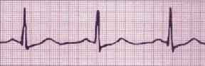 Learning how to read electrocardiograms (EKGs): Can we calculate the rate?